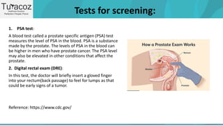 Prostate Cancer by Dr Ankita Purkite | PPTX