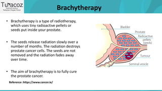 Prostate Cancer by Dr Ankita Purkite | PPTX