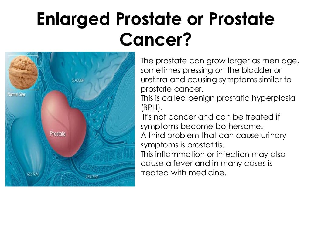 Prostate cancer cause defined symptom risk factors