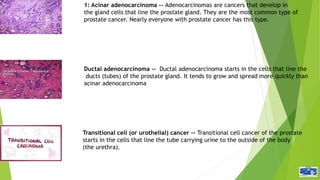 Prostate cancer symptoms, types & treatment | PPTX