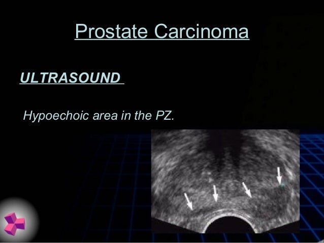 Prostate Carcinoma