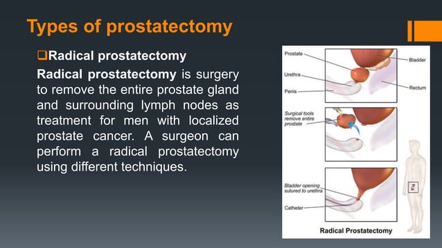 prostatectomy with urinary incontinence-1 (1).pdf