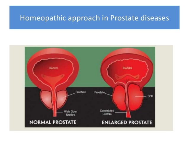Prostate disease prevention and new guidelines