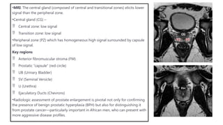 PROSTATE ENLARGEMENT: BPH and prostate cancer.pptx