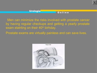 Prostate Exam | PPS