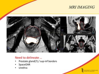 Prostate Hypofractionation and SBRT Fundamentals | PDF