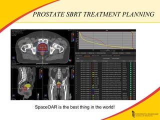 Prostate Hypofractionation and SBRT Fundamentals | PPT
