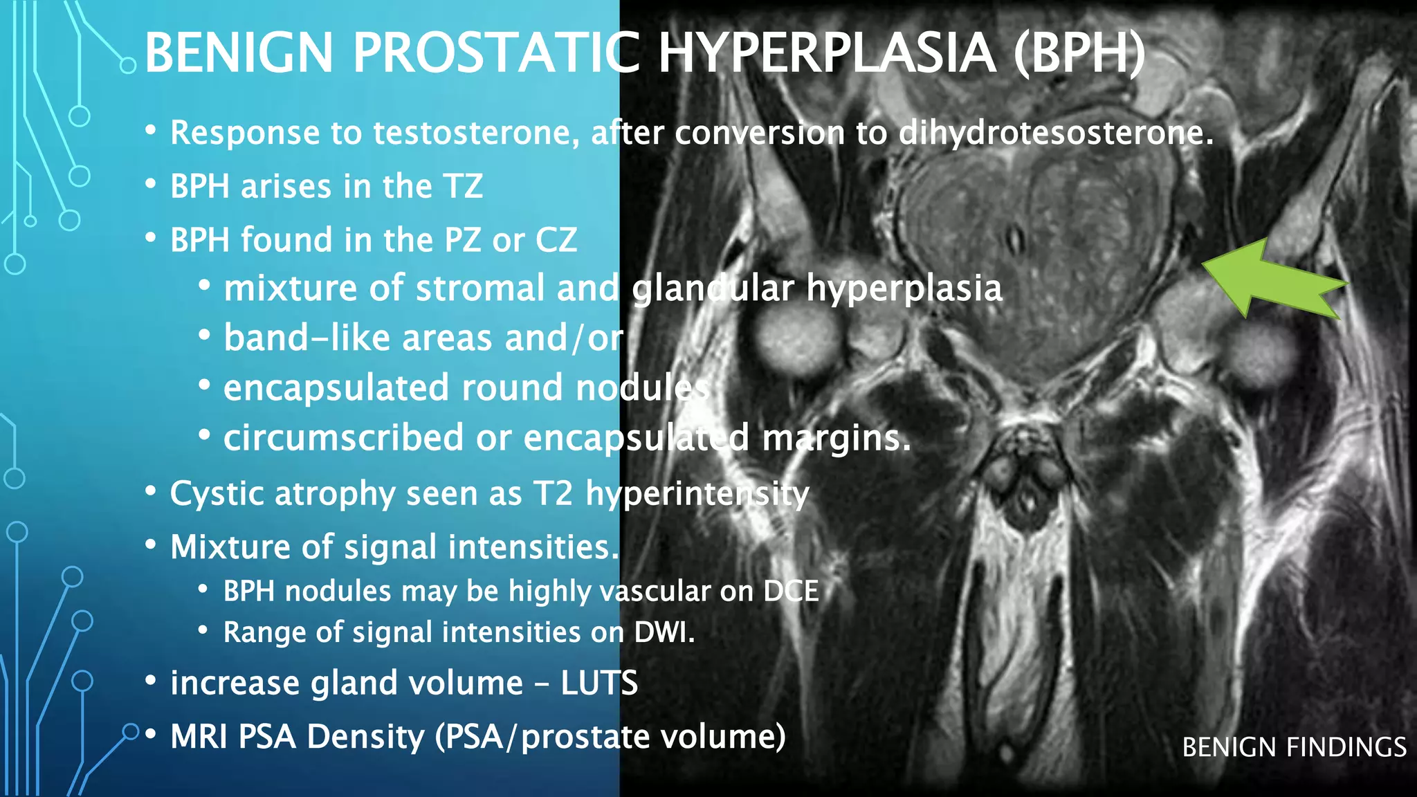 Prostate Imaging - PI-RADS v2.1 | PPTX