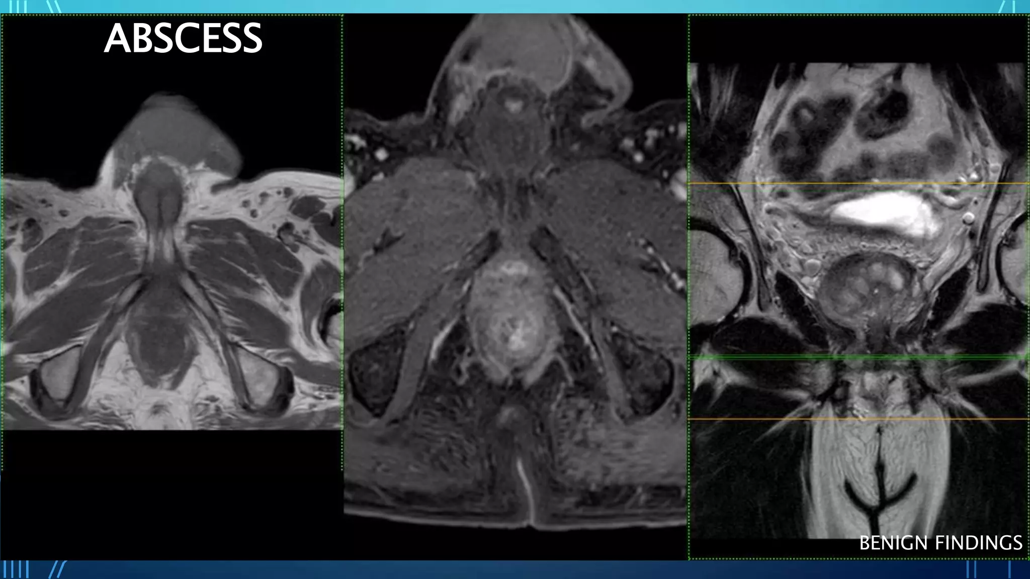 Prostate Imaging - PI-RADS v2.1 | PPTX