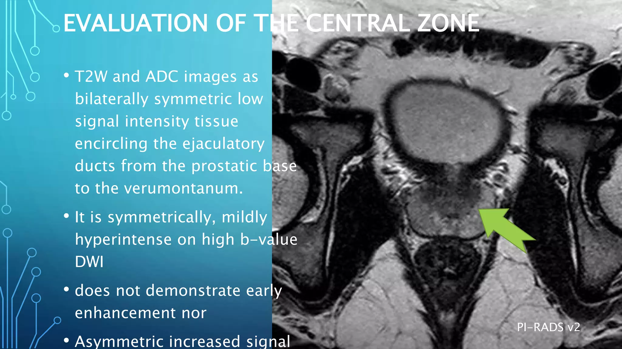 Prostate Imaging - PI-RADS v2.1 | PPTX