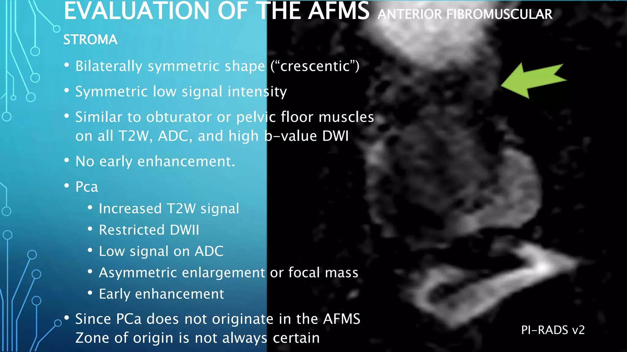 Prostate Imaging - PI-RADS v2.1 | PPTX