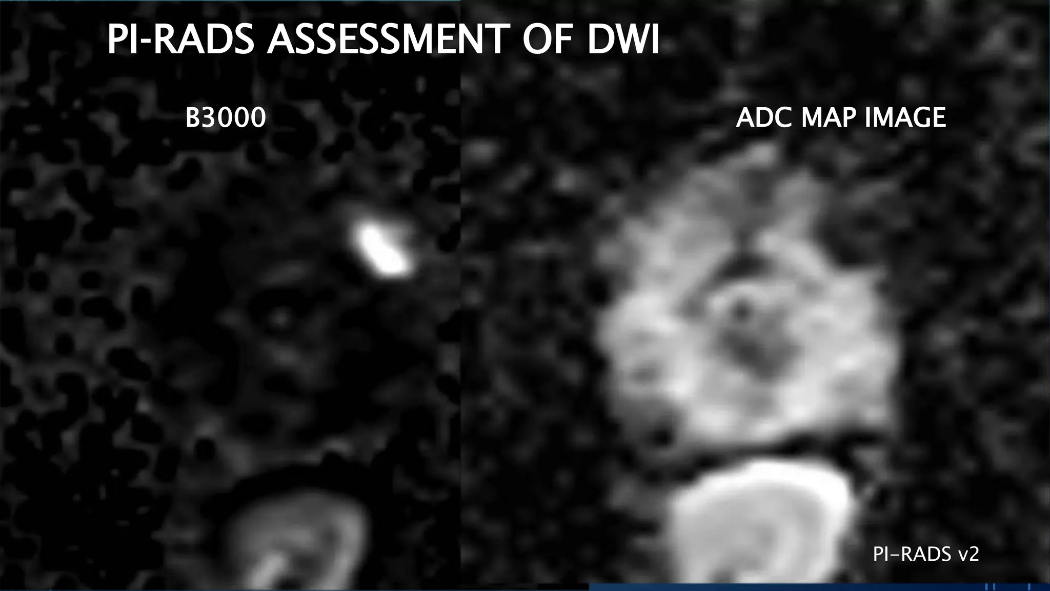 Prostate Imaging - PI-RADS v2.1 | PPTX