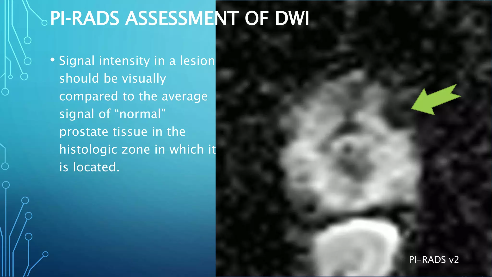 Prostate Imaging - PI-RADS v2.1 | PPTX