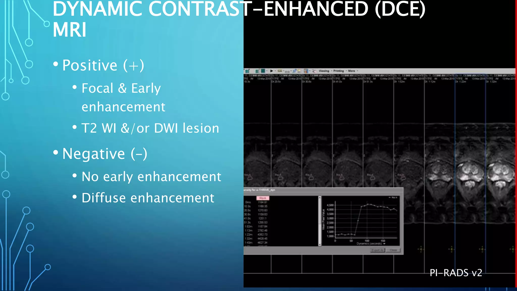 Prostate Imaging - PI-RADS v2.1 | PPTX