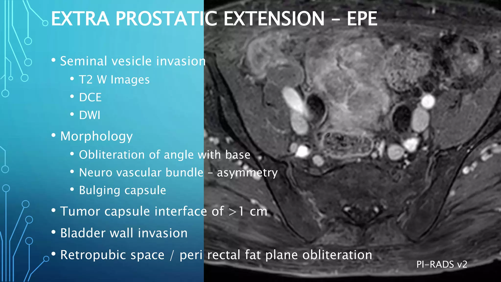 Prostate Imaging - PI-RADS v2.1 | PPTX