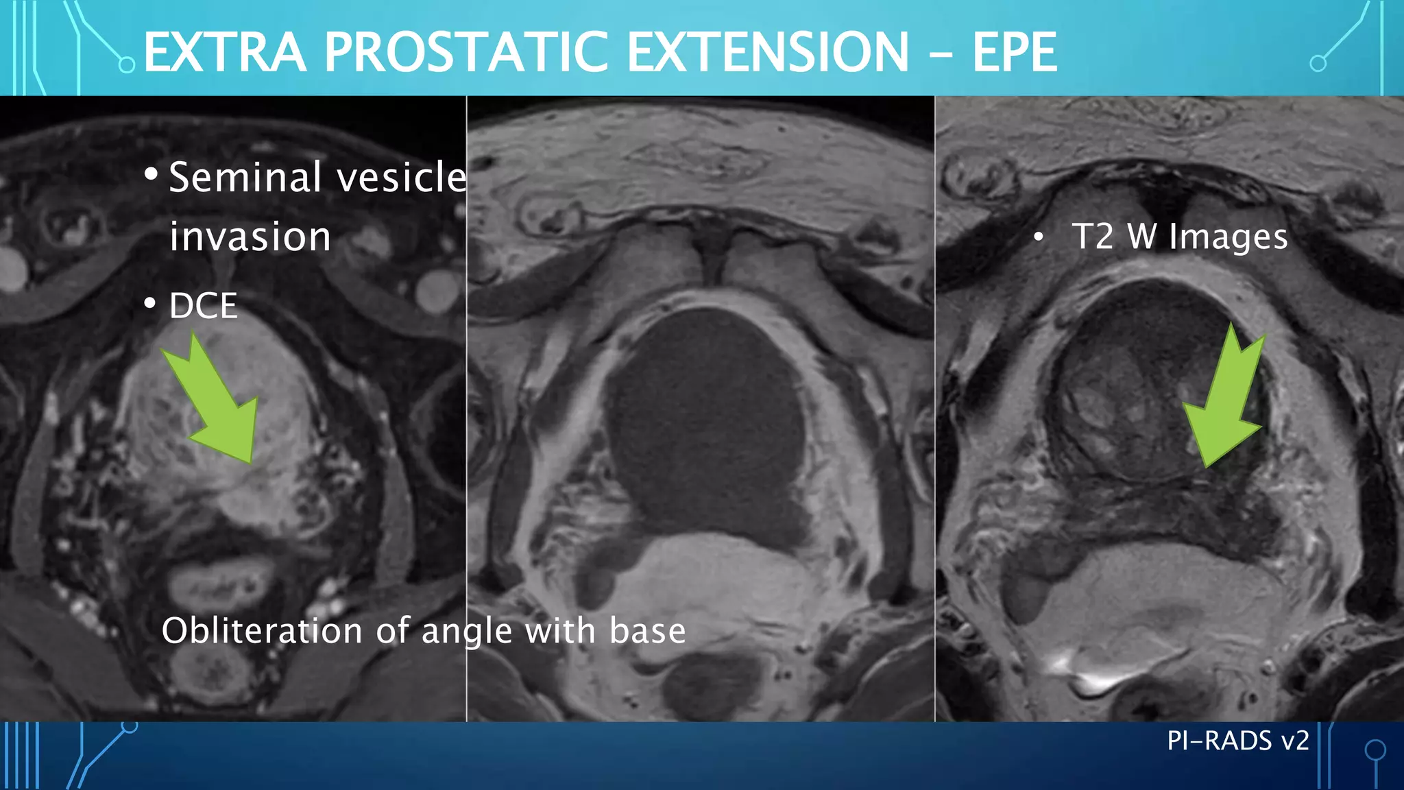 Prostate Imaging - PI-RADS v2.1 | PPTX