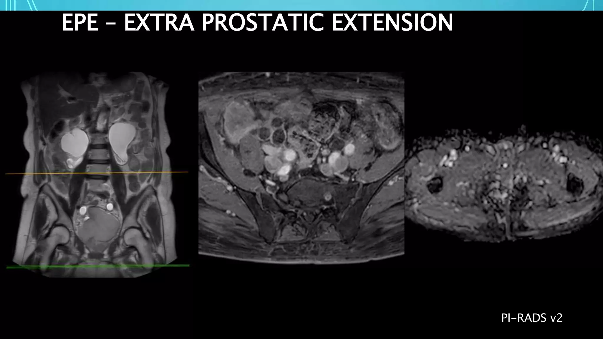 Prostate Imaging - PI-RADS v2.1 | PPTX