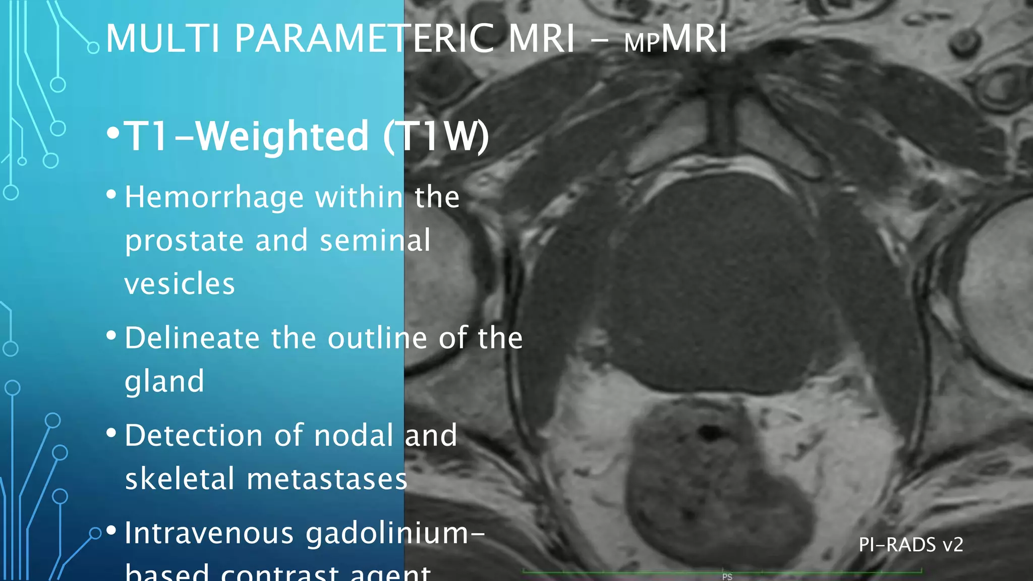 Prostate Imaging - PI-RADS v2.1 | PPTX