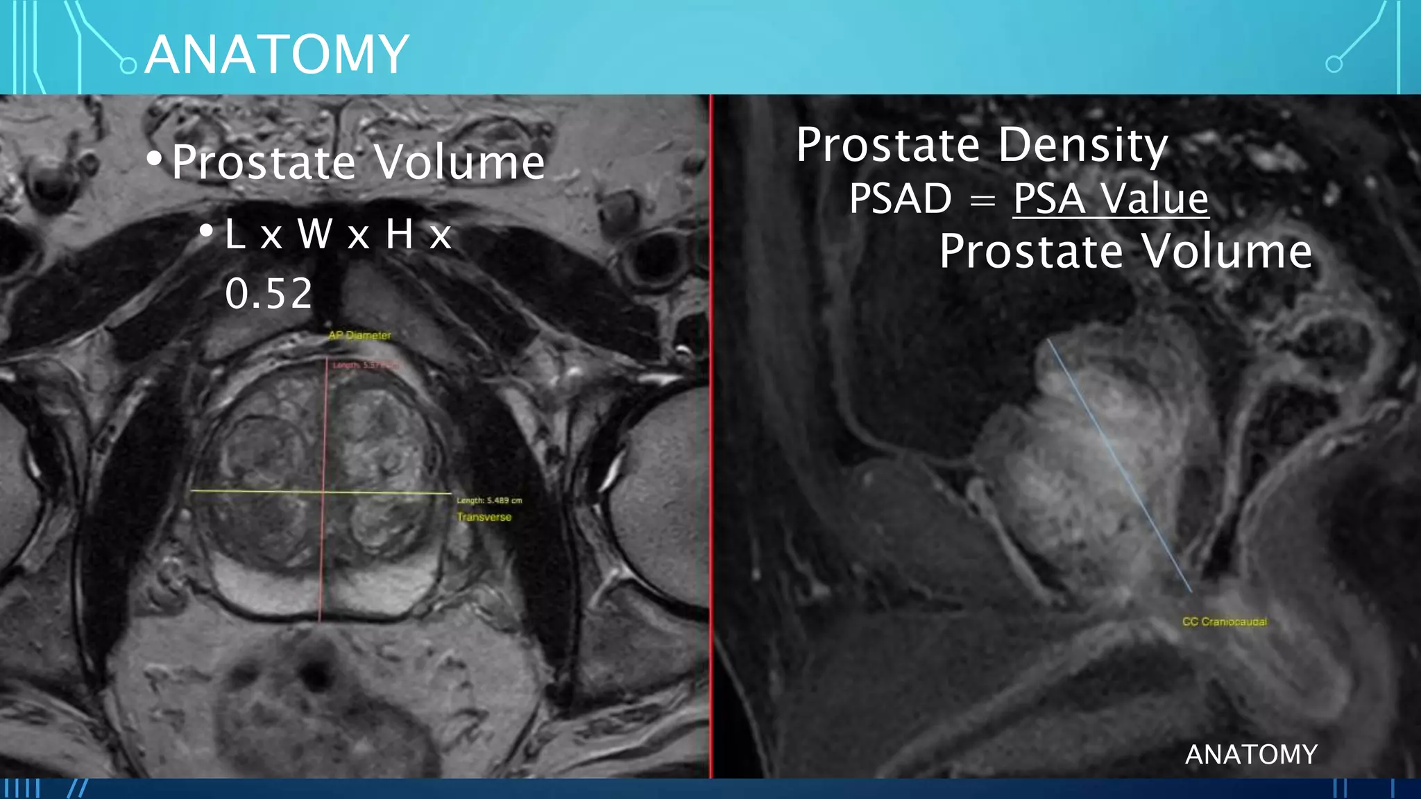 Prostate Imaging - PI-RADS v2.1 | PPTX