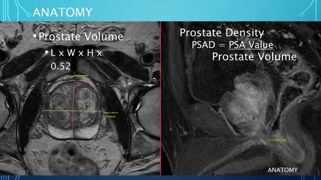 Prostate Imaging - PI-RADS v2.1 | PPTX