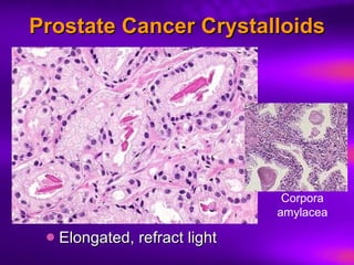 Prostate Pathology | PPT