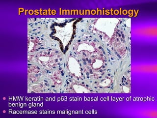 Prostate Pathology | PPT