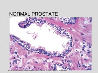 Prostate pathology, Dr. Sufia Husain, March 2018 | PPT