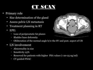 Anatomy, pathology an staging work up of prostate cancer | ODP