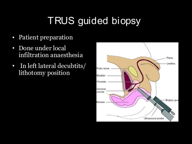 Anatomy, pathology an staging work up of prostate cancer