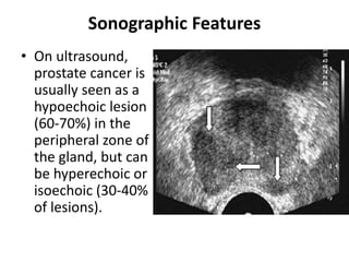 Prostate ultrasound (basic) | PPTX