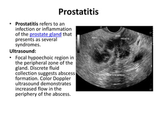 Prostate ultrasound (basic) | PPTX