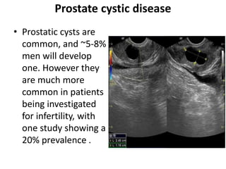 Prostate ultrasound (basic) | PPTX