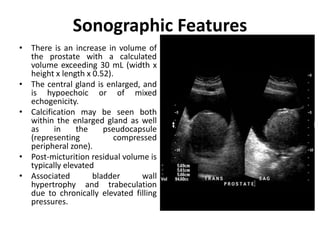 Prostate ultrasound (basic) | PPTX
