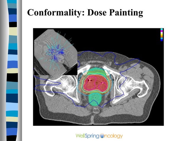 Radiotherapy for Prostate Cancer | PPT | Physical Therapy | Wellness
