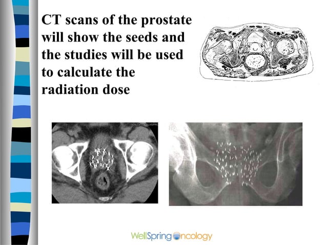 Radiotherapy for Prostate Cancer | PPT | Physical Therapy | Wellness