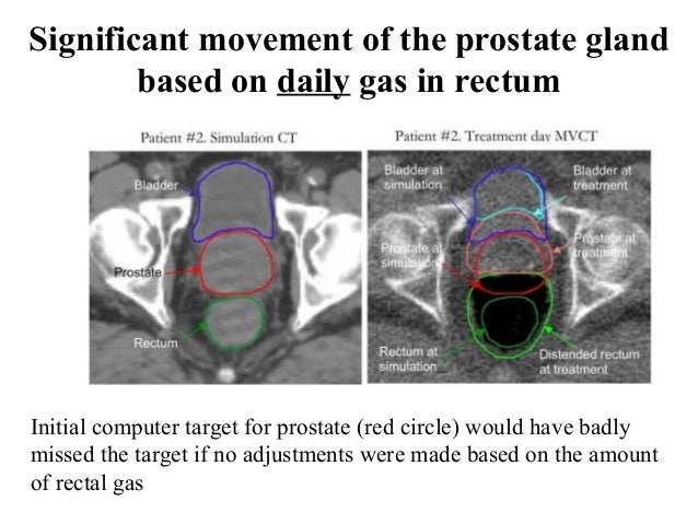 Radiotherapy for Prostate Cancer