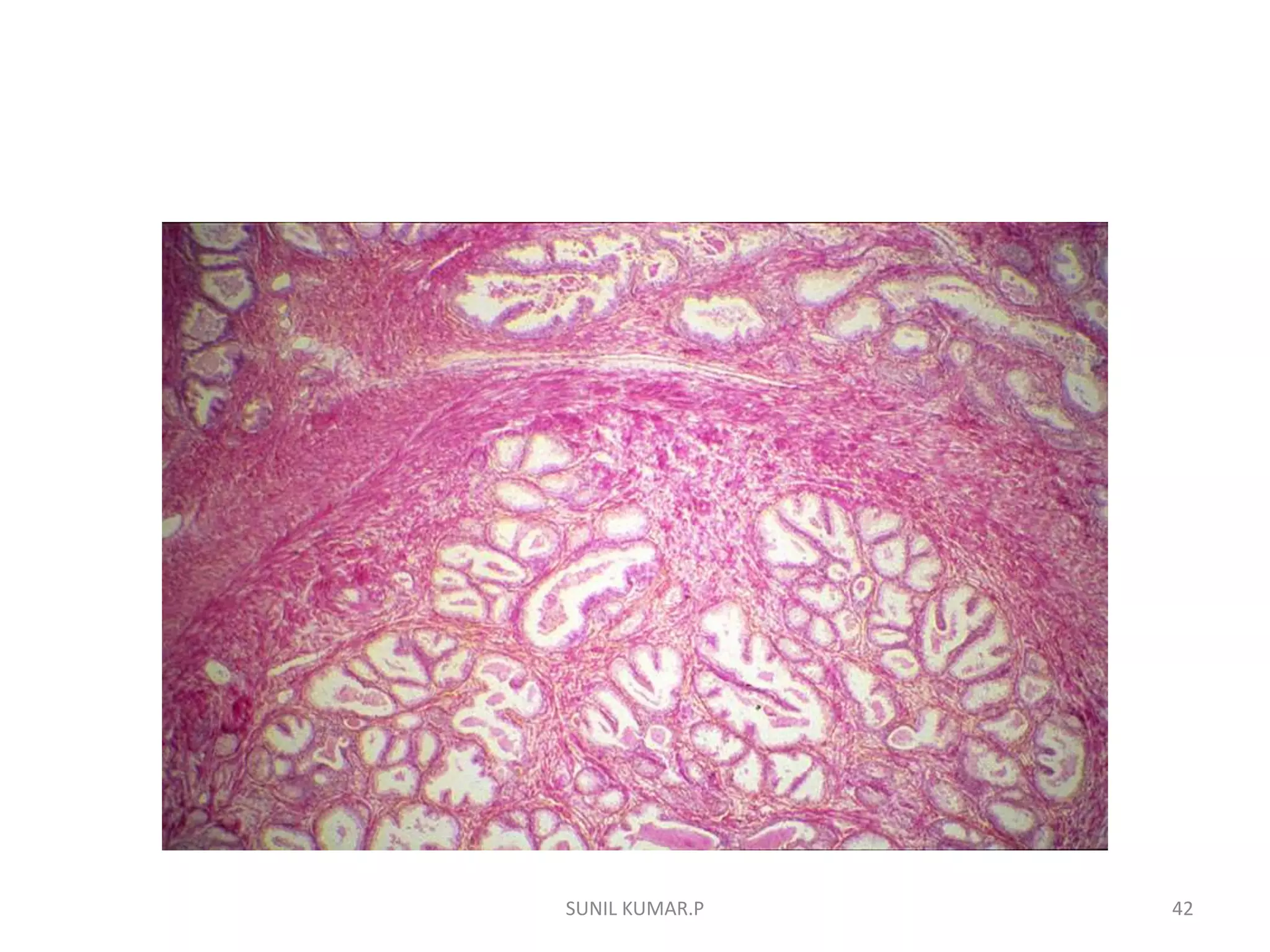 Prostatitis Pptx