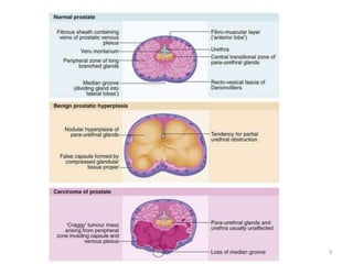 Prostatitis | PPTX