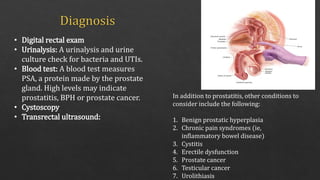 prostatitis.pptx