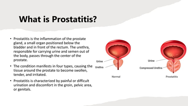 Prostatitis: Explained Symptoms, Causes, & Treatment Guide | PPTX ...