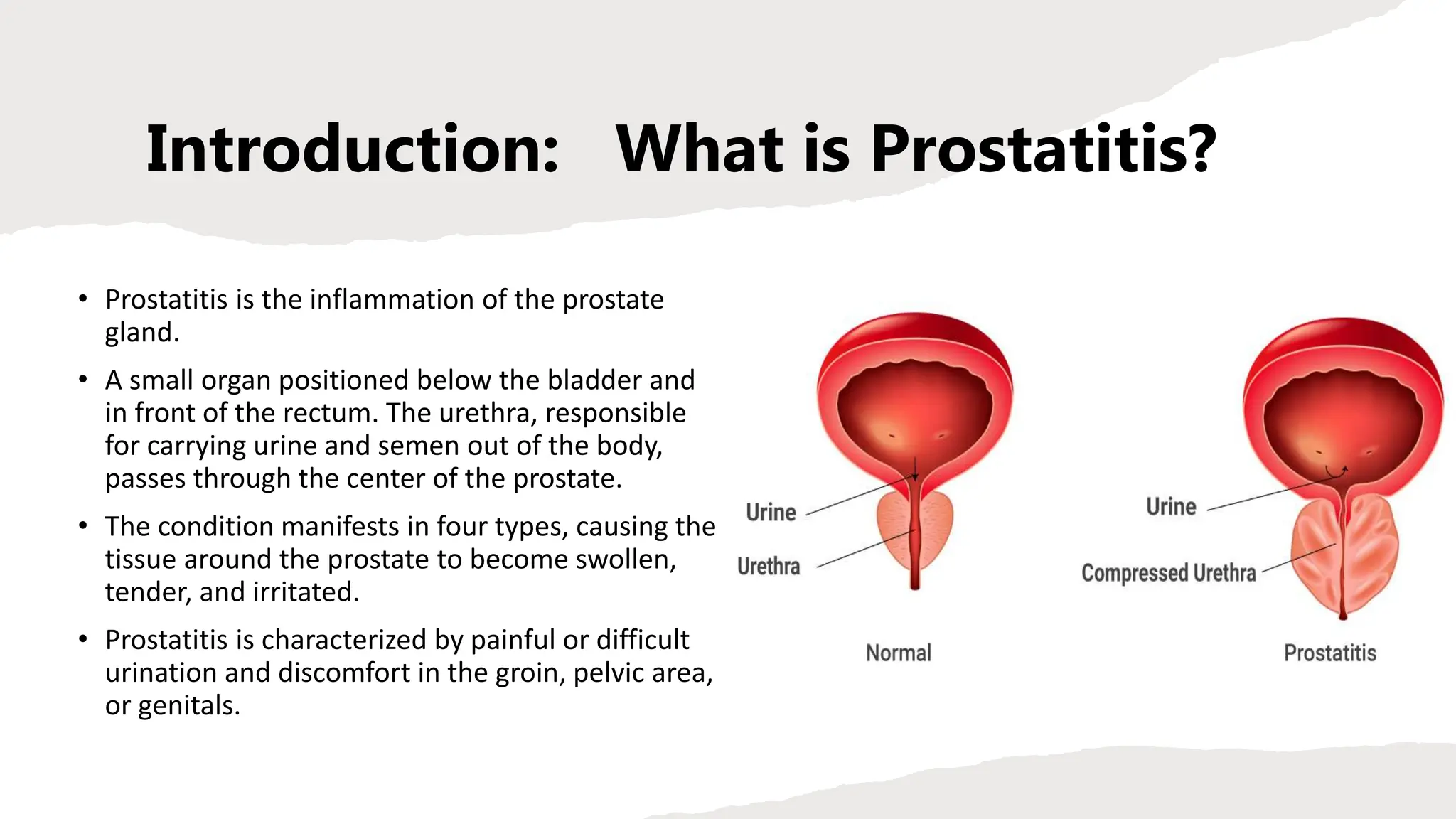 Prostatitis both Acute and Chronic .pptx