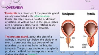 Prostatitis-ppt (1).pptx