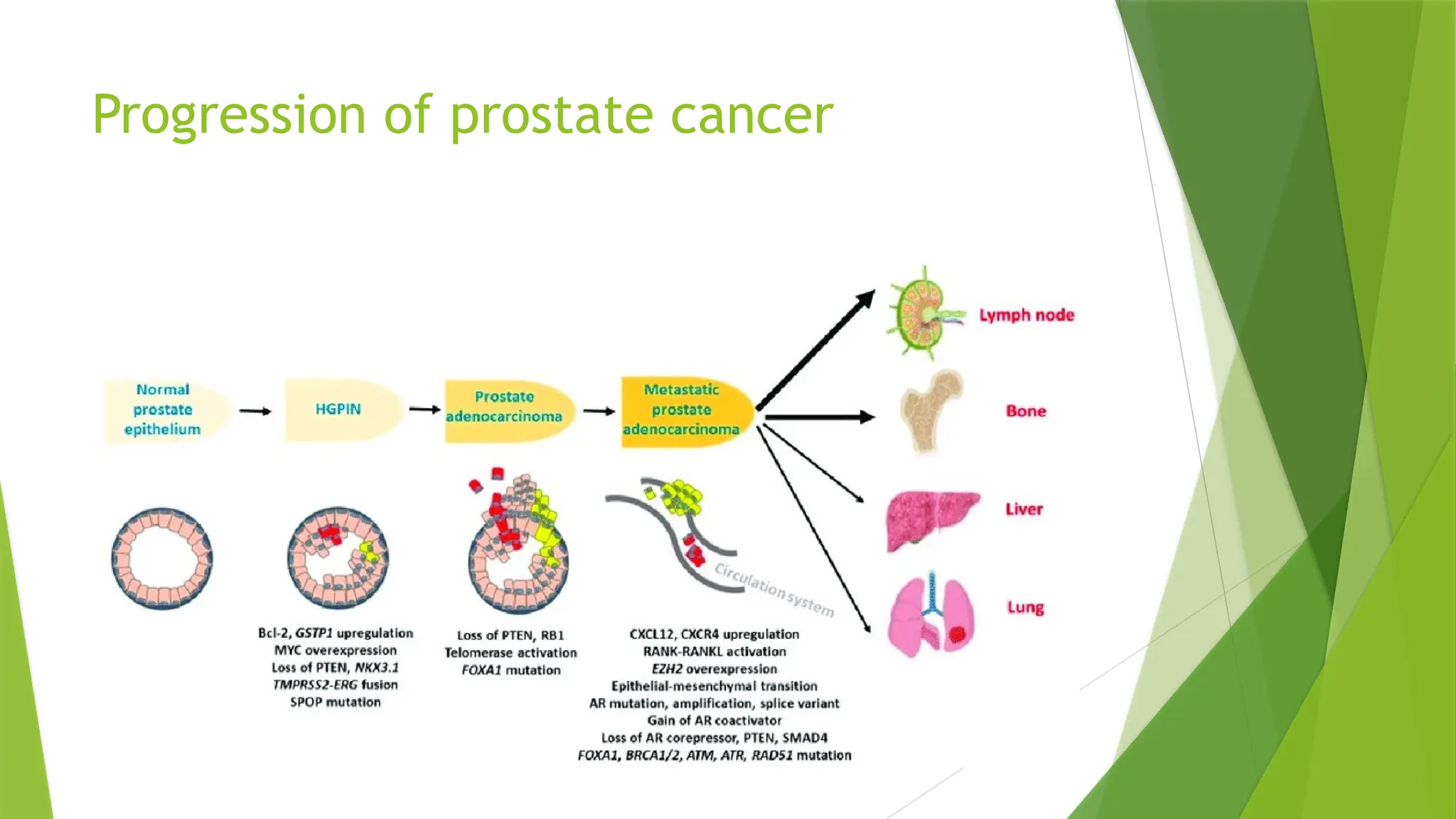 Prostatitis%20and%20prostate%20cancer.pptx