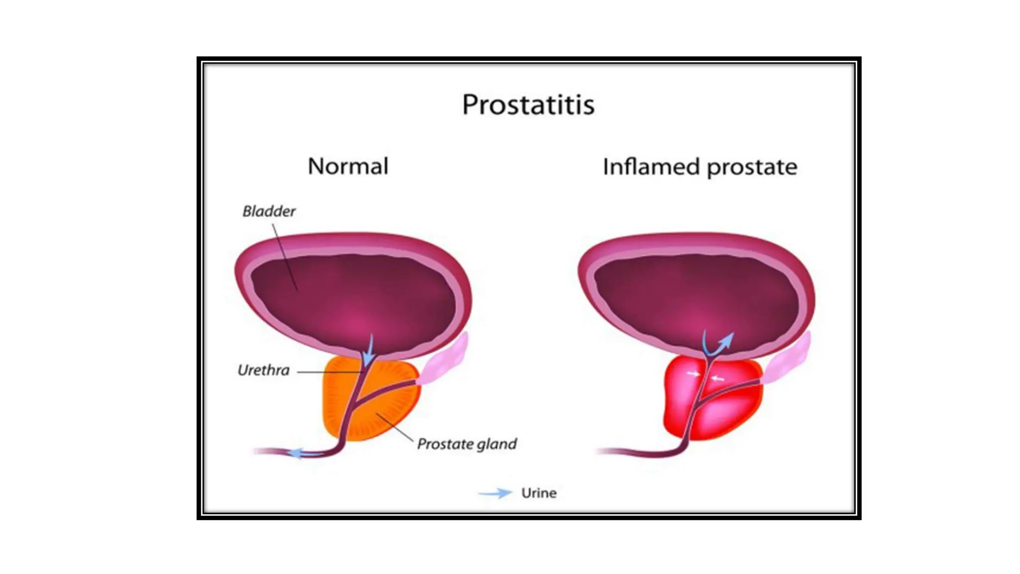 Prostatitis & Prostate Cancer.pptx (Male Reproductive System) | PPTX