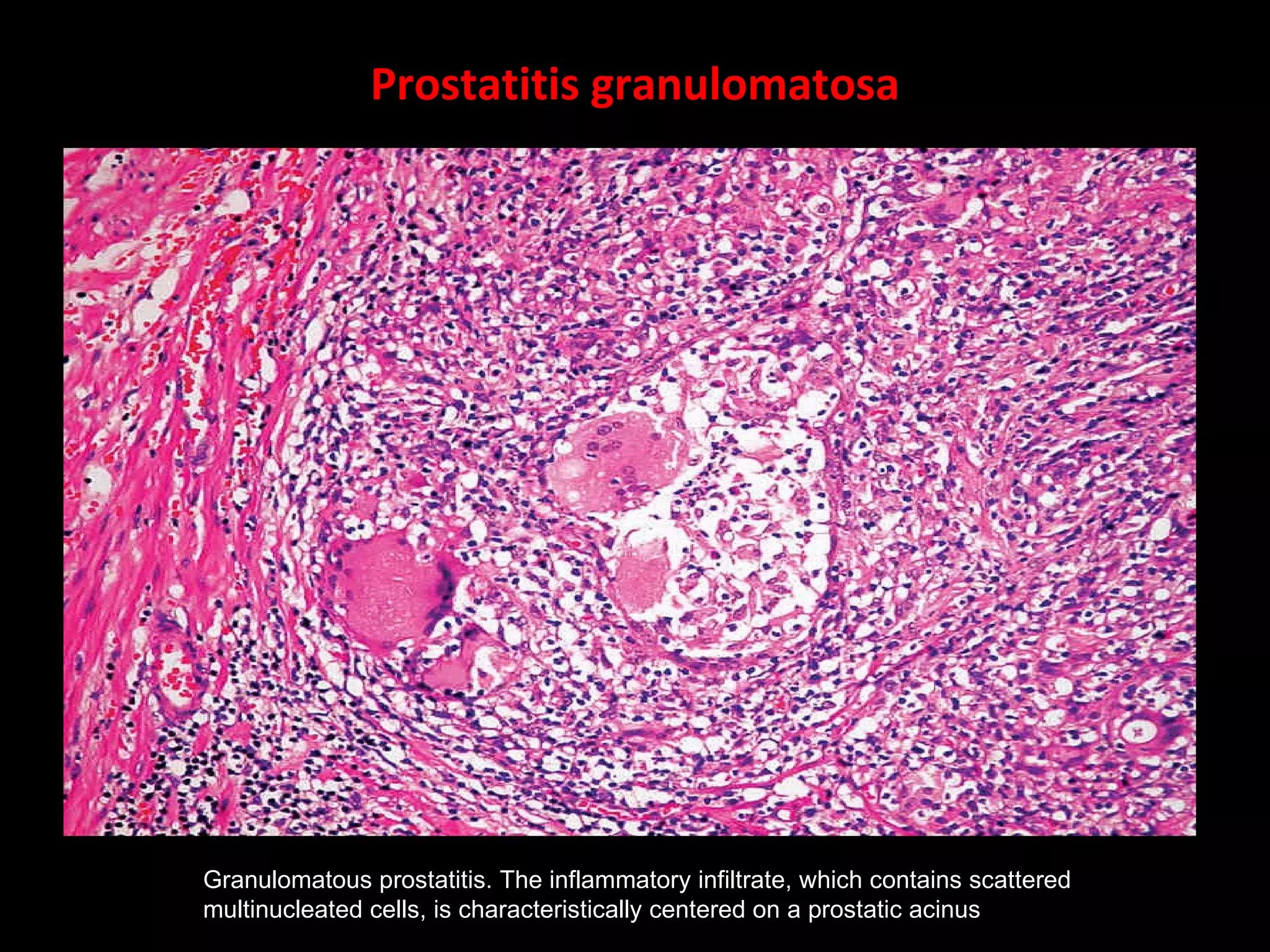 Patologi Prostat | PPT