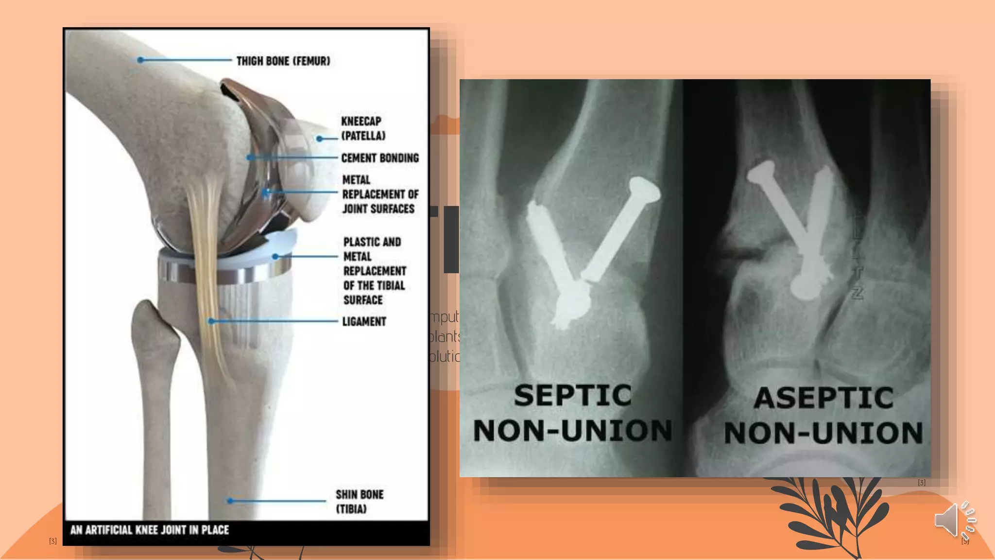 Tibial Prosthesis Biomaterials: Co-Polymers & Optimizing Properties | PPT