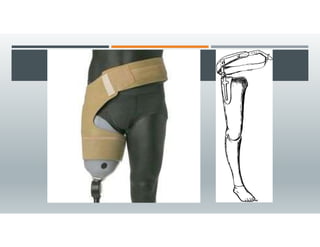 Prosthesis 15. Transfemoral Prosthesis.pdf