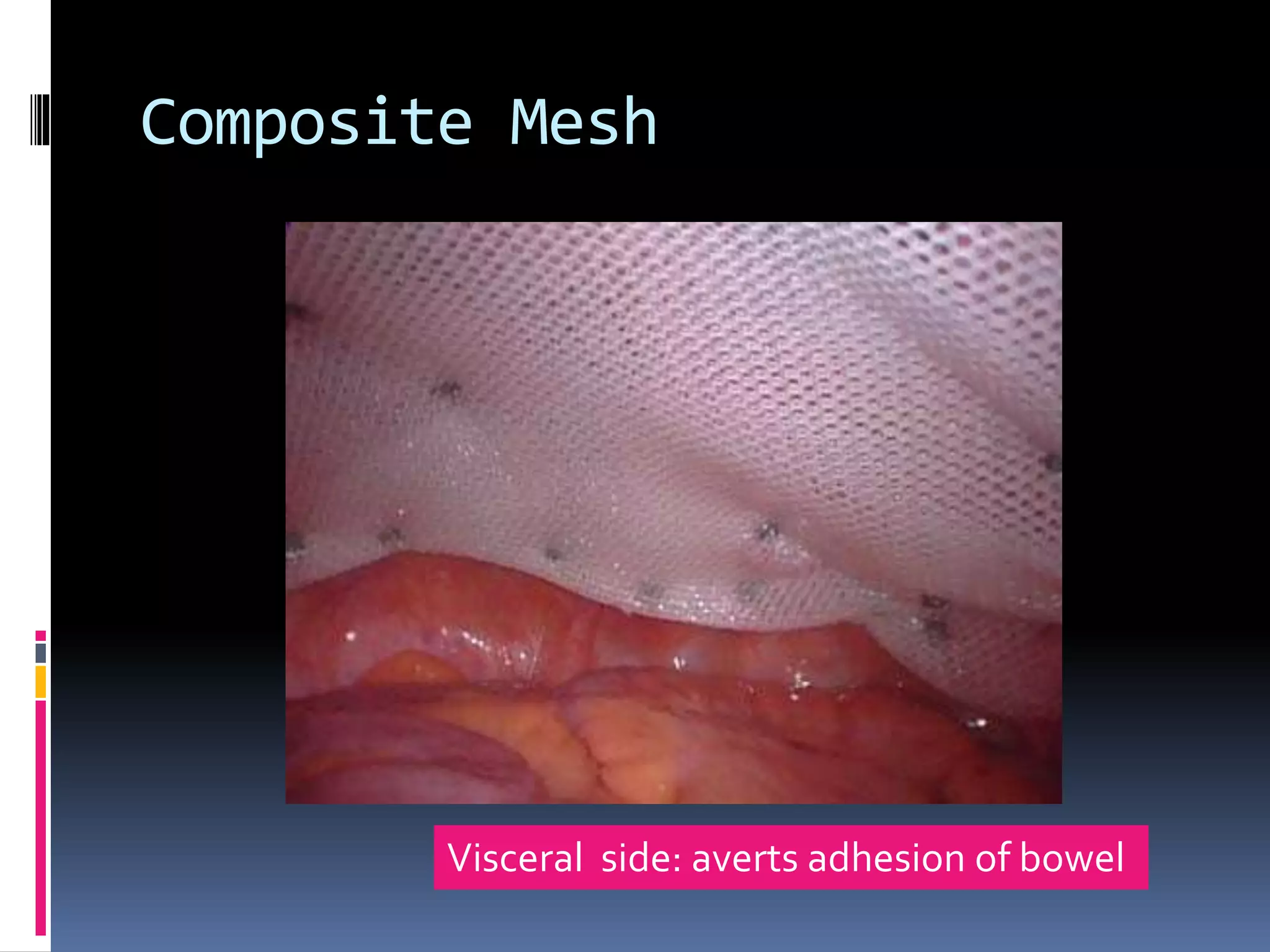 Prosthesis and fixation device | PPTX | Death, Injury, or Military ...