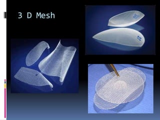 Prosthesis and fixation device | PPTX | Death, Injury, or Military ...