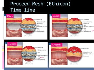 Prosthesis and fixation device | PPTX | Death, Injury, or Military ...